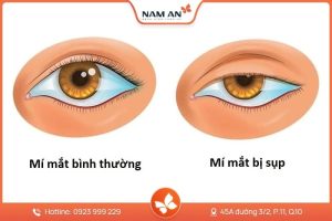 Điều trị sụp mí mắt | Phương pháp nào tốt, hiệu quả cao?