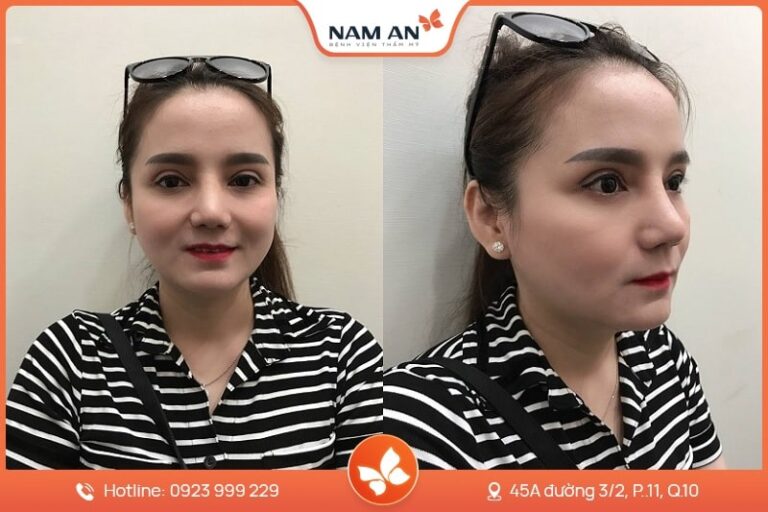 Điều Trị Sụp Mi Mắt Chuẩn Y Khoa Tại BV Thẩm Mỹ Nam An