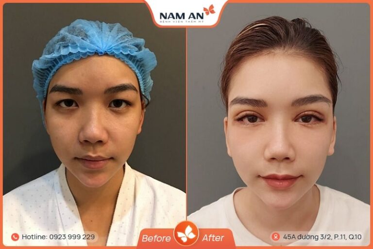 Điều Trị Sụp Mi Mắt Chuẩn Y Khoa Tại BV Thẩm Mỹ Nam An